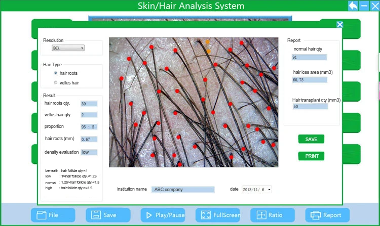 Pc Connection Scalp Forllicle Analyzer Giving Report And Recommend ...