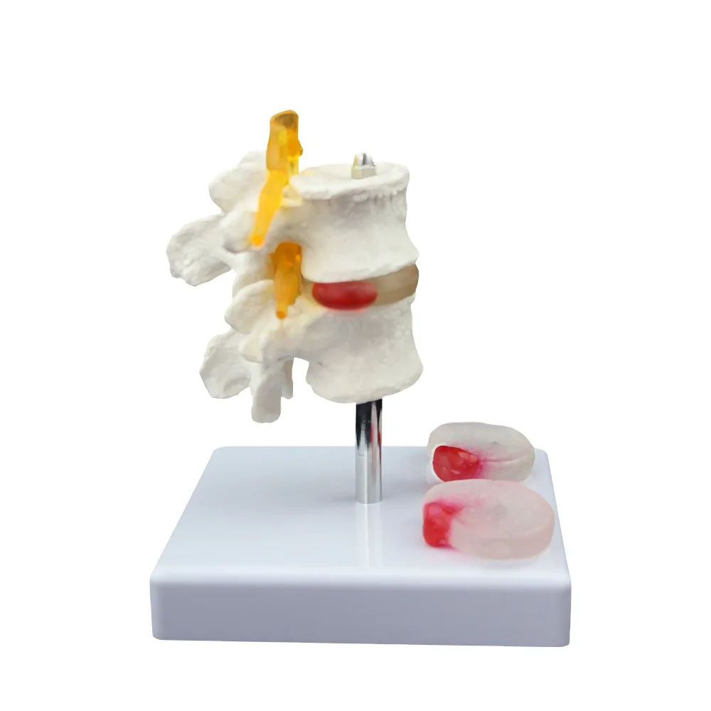Frt038 Lumbar Spine Pathology Herniat Disc Model Pathological Human ...
