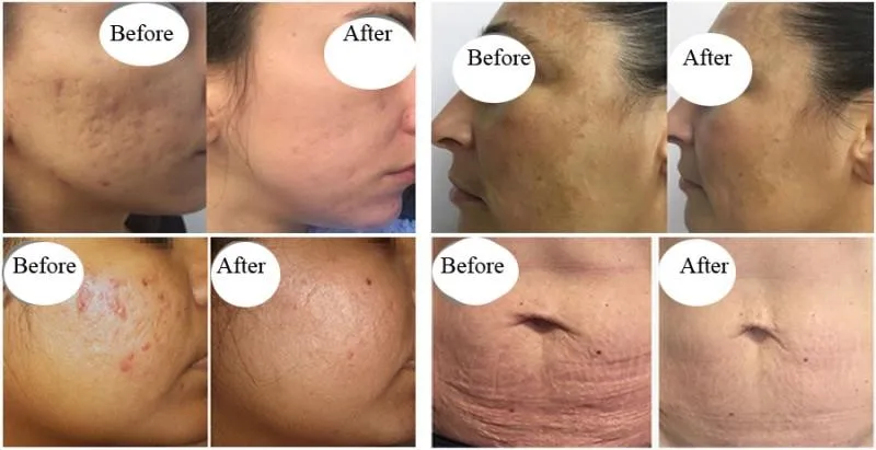 Tixel Machine for Collagen Regeneration and Skin Renewal