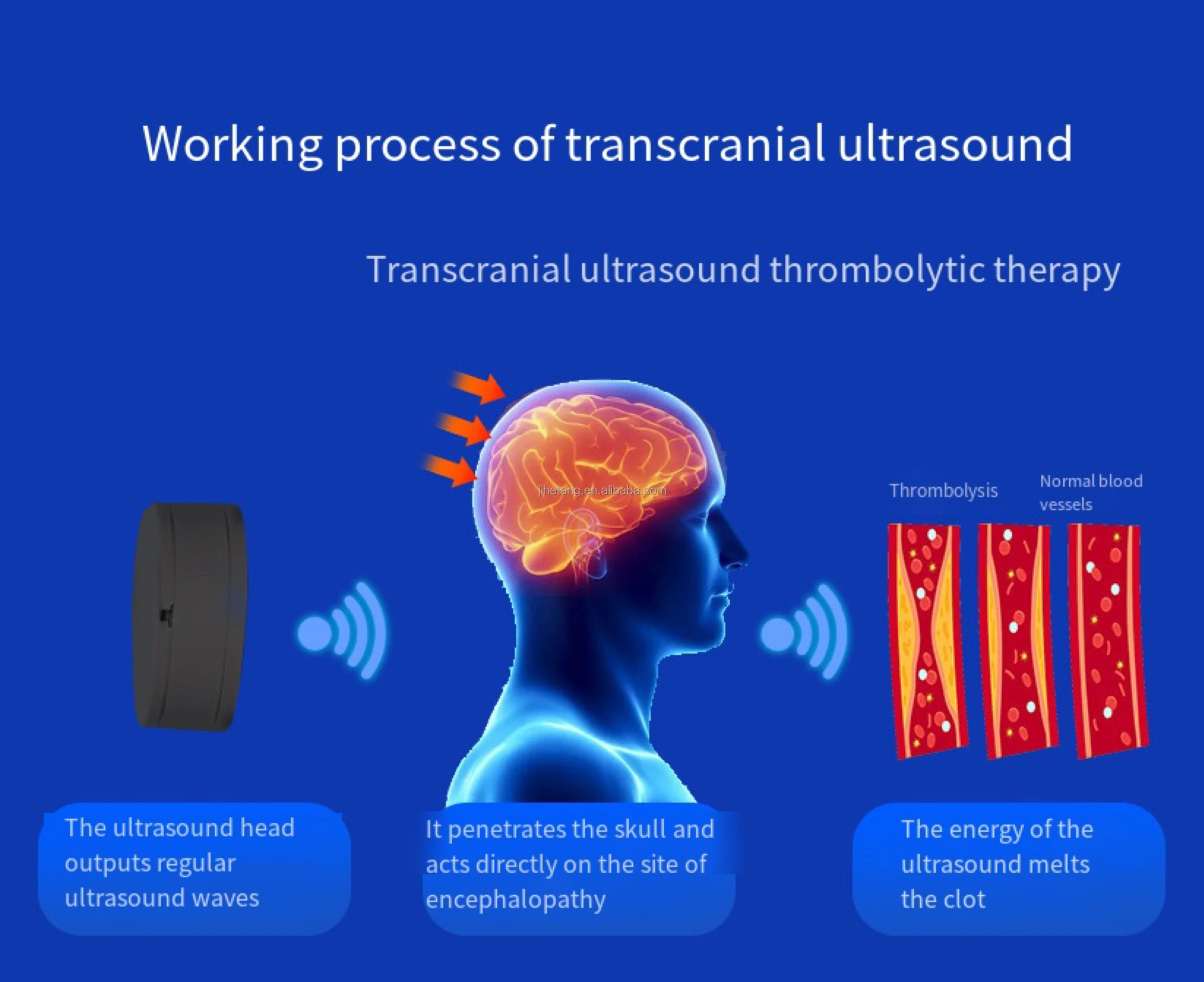 595mT Transcranial Magnetic Stimulation Medical Stroke Depression ...