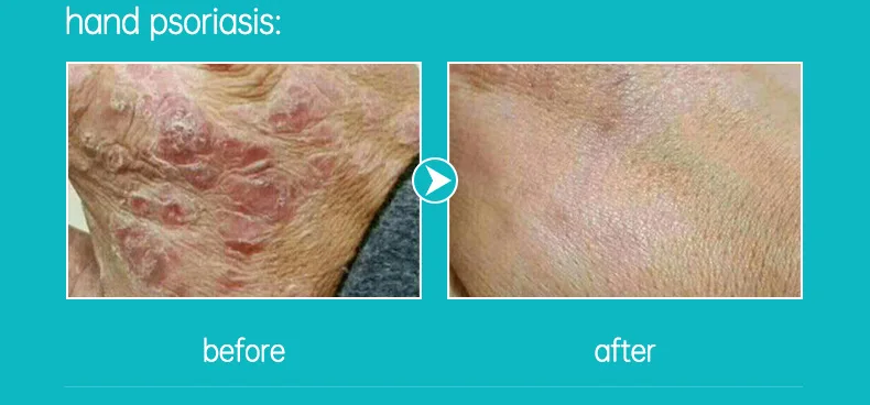 Skin Pruritus Ointment Skin Ringworm Wang Ointment Dispel Psoriasis ...