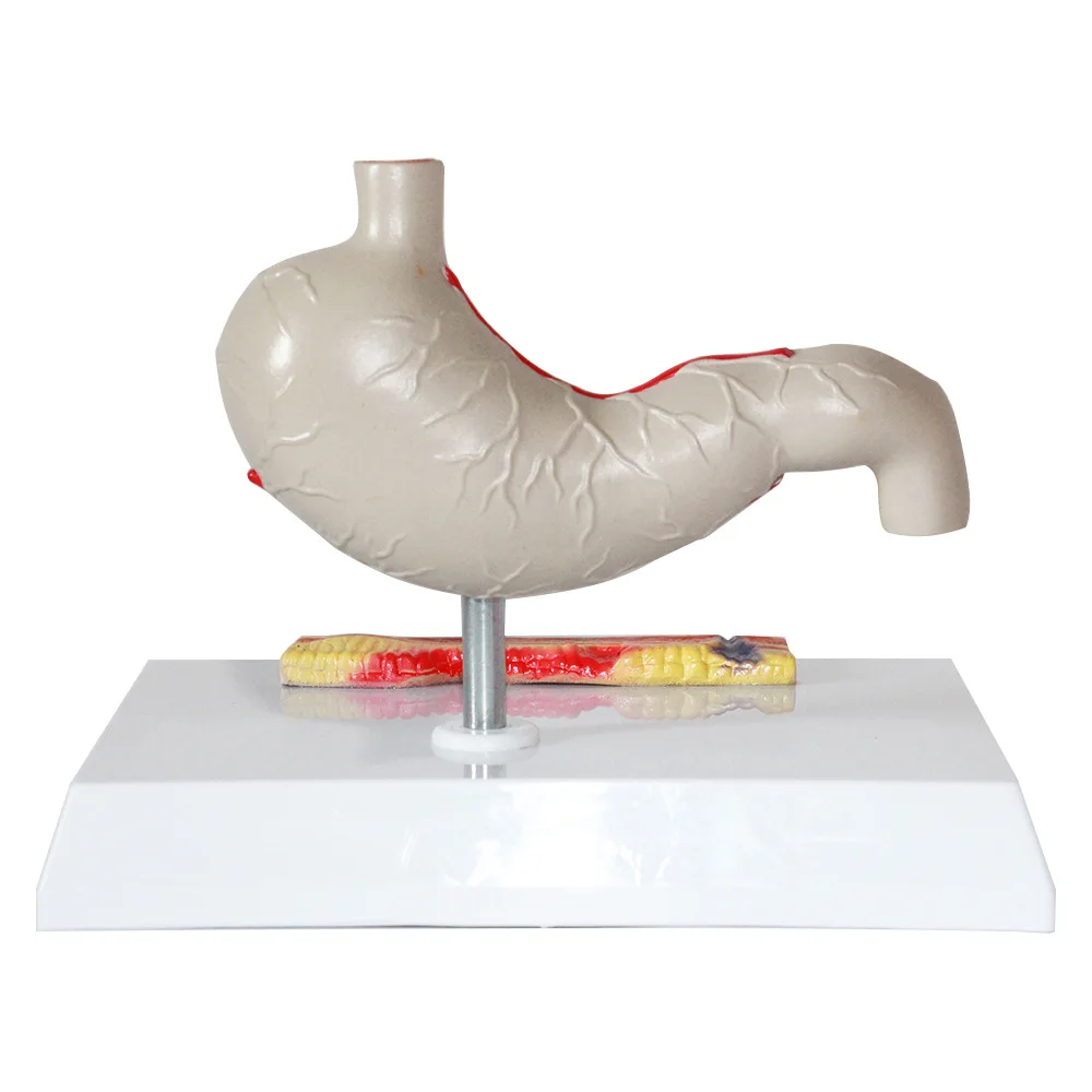 Anatomical Model of Chronic Pathological Gastritis & Ulcer