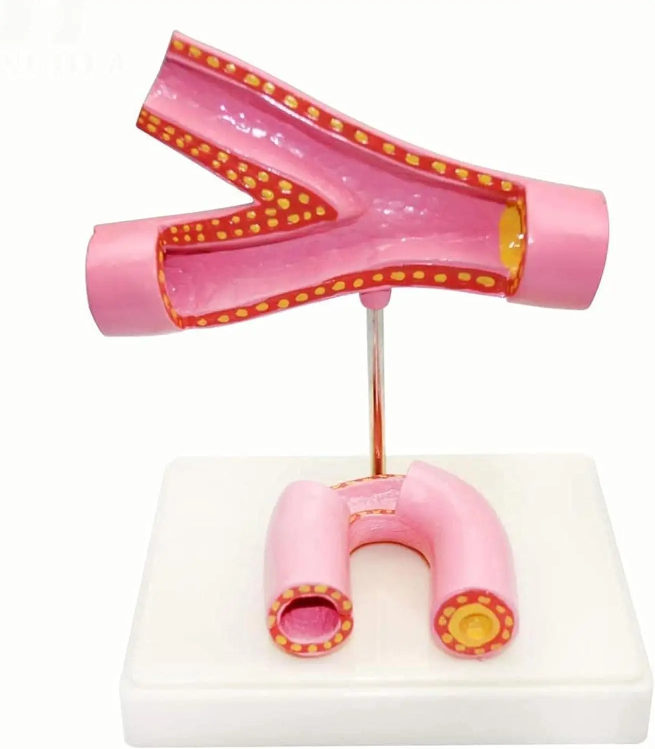 Anatomical Human Blood Vessel Model Arteriosclerosis Model With ...