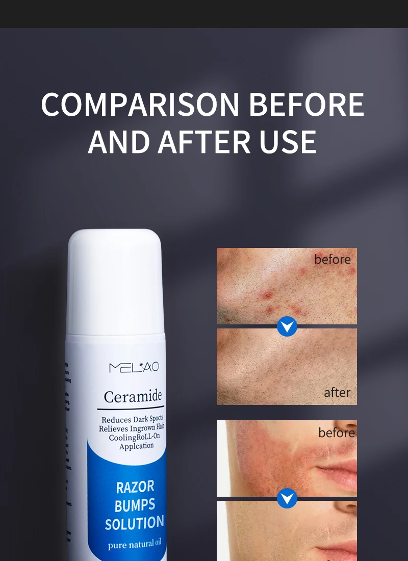 Razor Bump Solution - Soften Skin & Prevent Ingrown Hairs