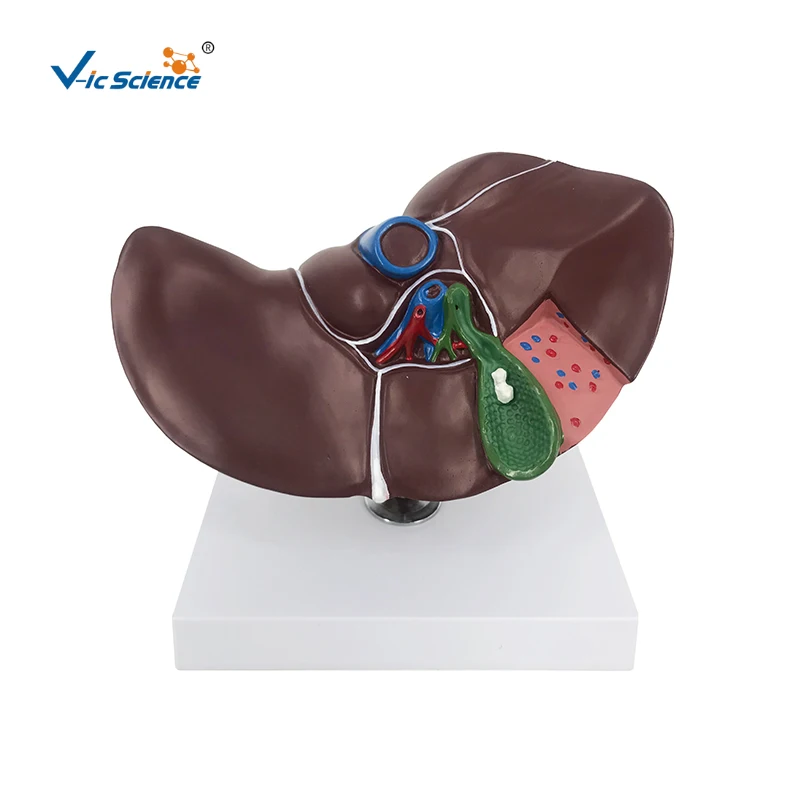 Human Model Anatomy Liver And Gallbladder With Gallstone Anatomy Model ...