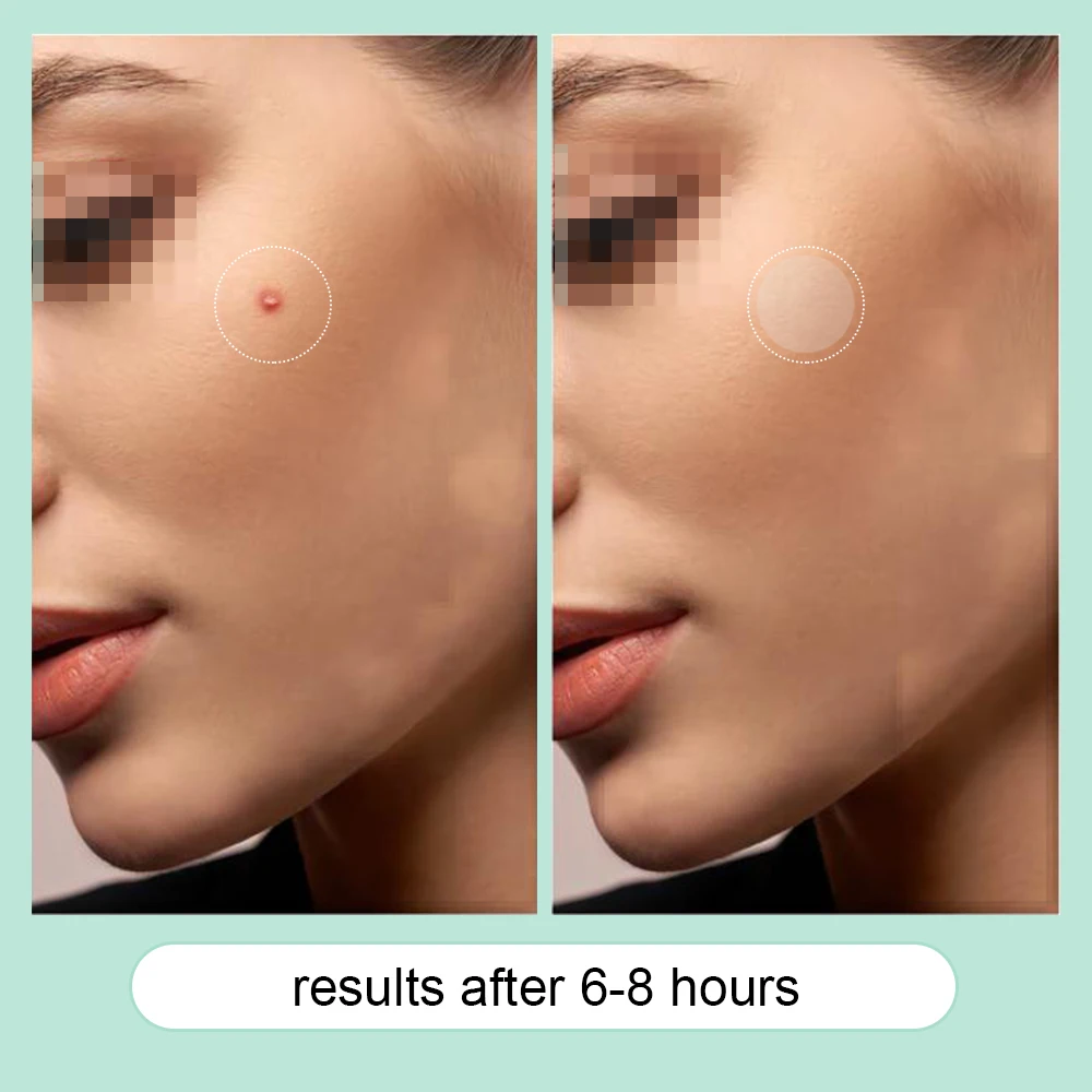 Transparent Invisible Acne Pimple Patch Spots Cover Cosmetic Pimple ...