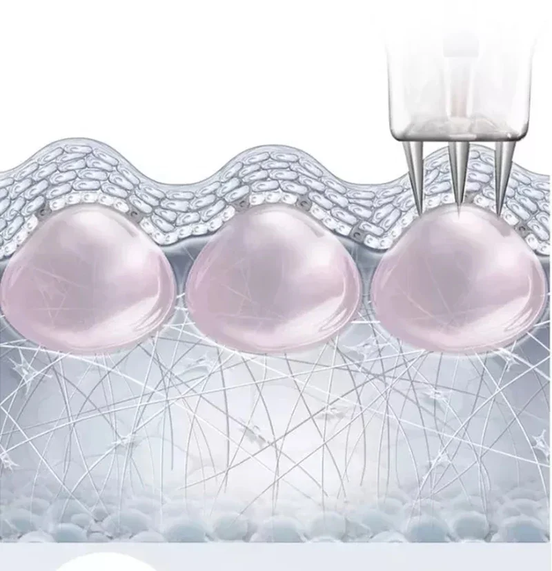 Nanosoft Microneedles Fillmed 3 Pin Needle 34g 1.0mm 1.2mm 1.5mm ...