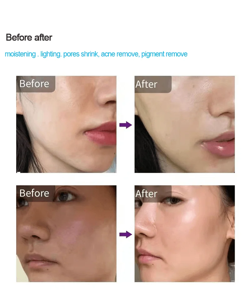 Korea 3rd Generation Vital Injector Mesotherapy 32g 9pin Needle Mesogun ...