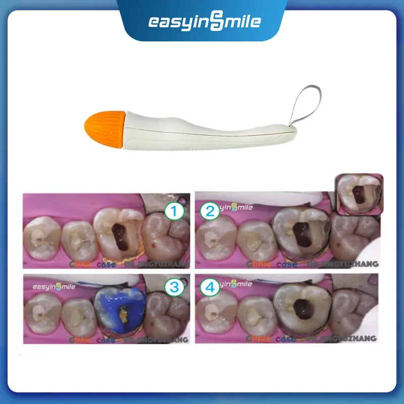 Easyinsmile Dental Matrix Profecto Sectional Matrix Bands Oral ...