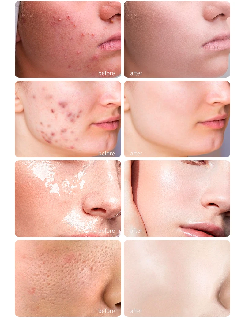 Quick Effect Rapid Rescue Oil Control Acne Spot Treatment Acne Essence ...