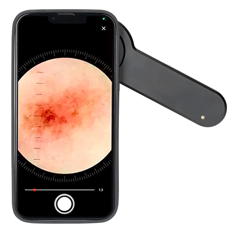 Mobile Phone Skin Analyzer Skin Cancer Diagnosis 10x Medical High ...
