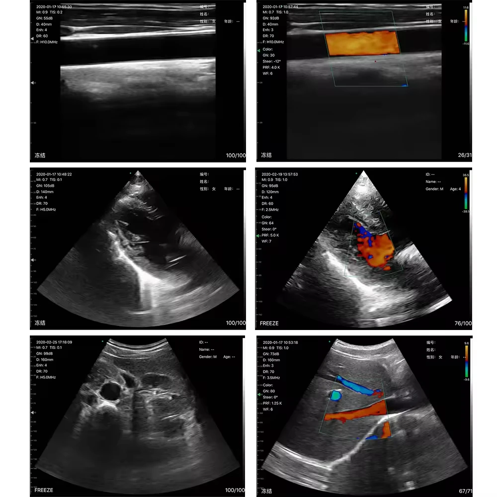 Mobile Point-of-care Ultrasound With High-frequency Linear Probe For ...