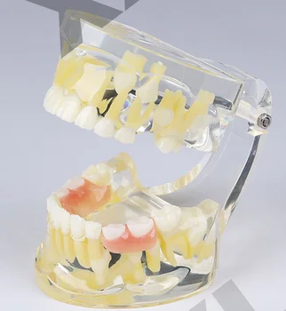Mix Dentition Dental Model With Permanent Teeth And Edentulous Baby ...