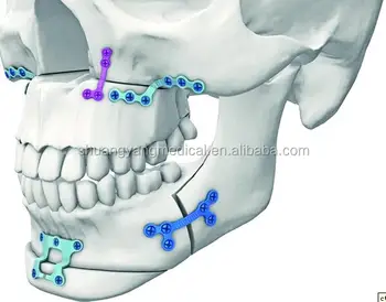 Maxillofacial Mini Plate For Titanium Fracture Plate - Buy Mini Plate ...