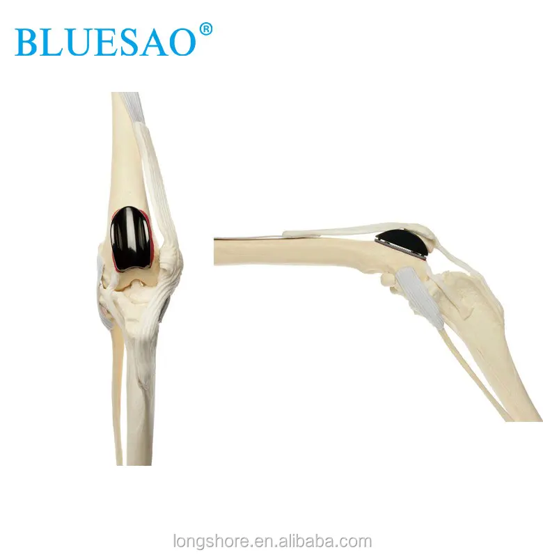 Patellar Groove Replacement Kit Implant Prosthesis And Trial Prothesis ...