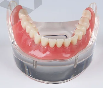 Mandibular Overdenture Restoration Dental Model With 2 Implants - Buy ...