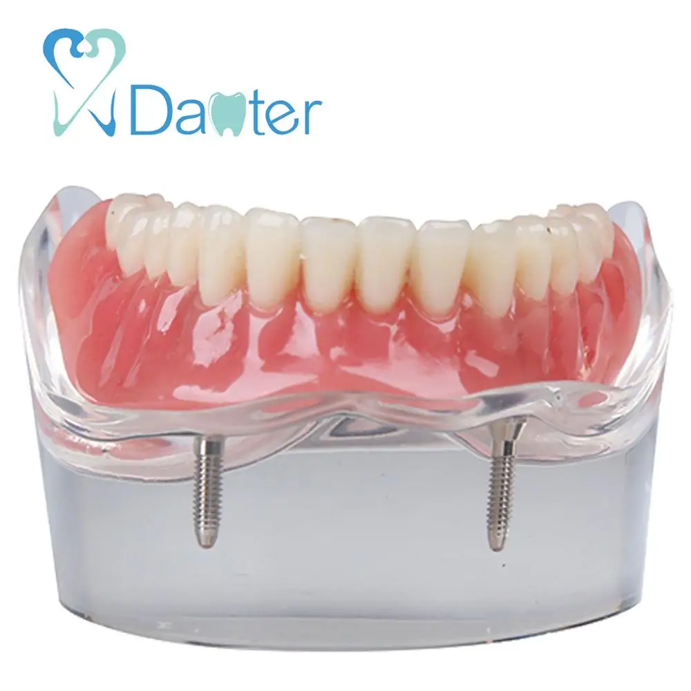 Dental Overdenture Interior Mandibular Lower With 2 Implants ...