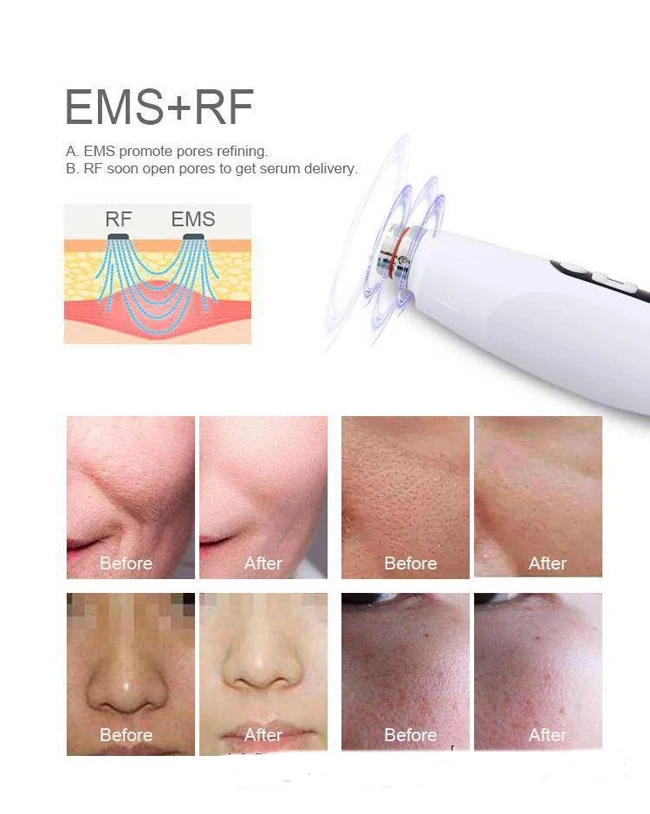 EMS Mesogun No Needle Meso Gun for Skin Rejuvenation SA-MP01 ...