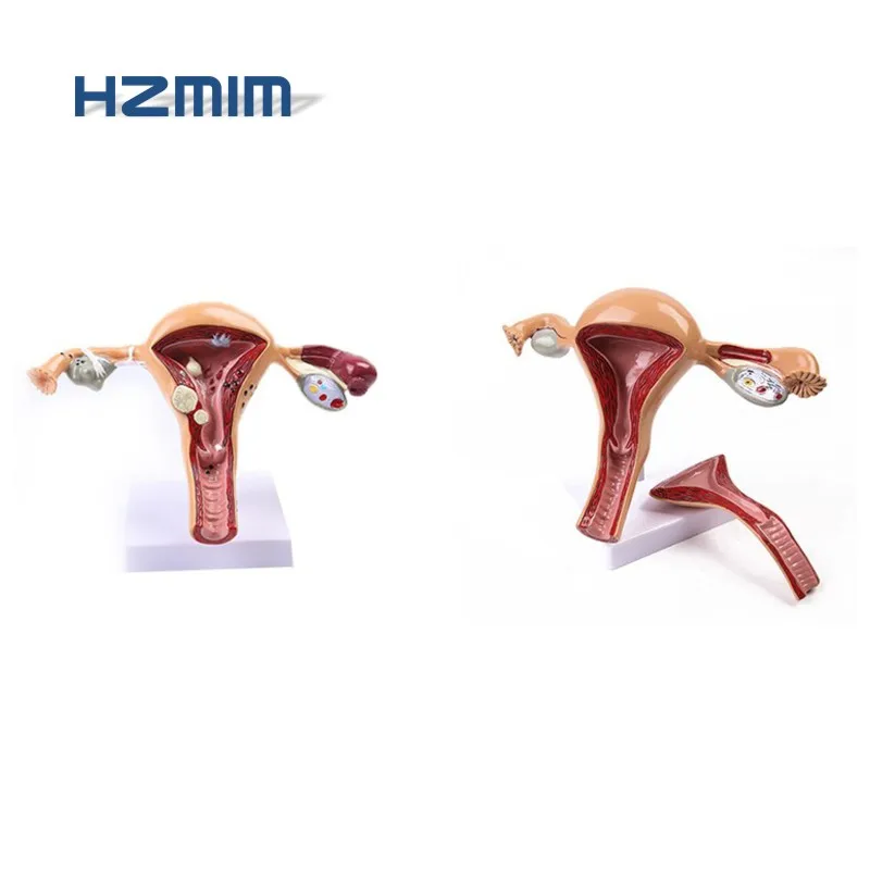 human anatomical uterus model, female womb model with pathology, Uterus ...