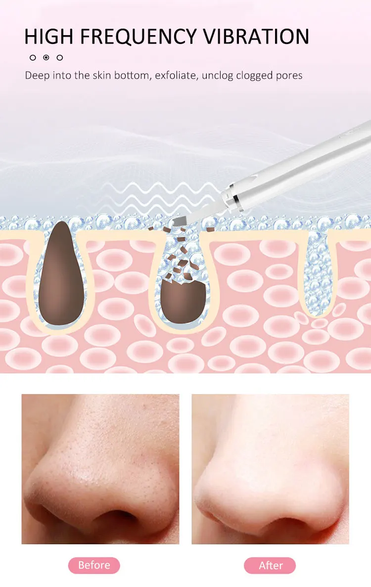 Ultrasonic Skin Scrubber - Deep Cleansing & Exfoliation