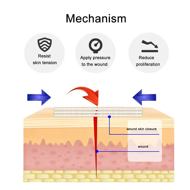 Adhesive Skin Laceration Closures Strip for Minor Cuts & Wounds ...