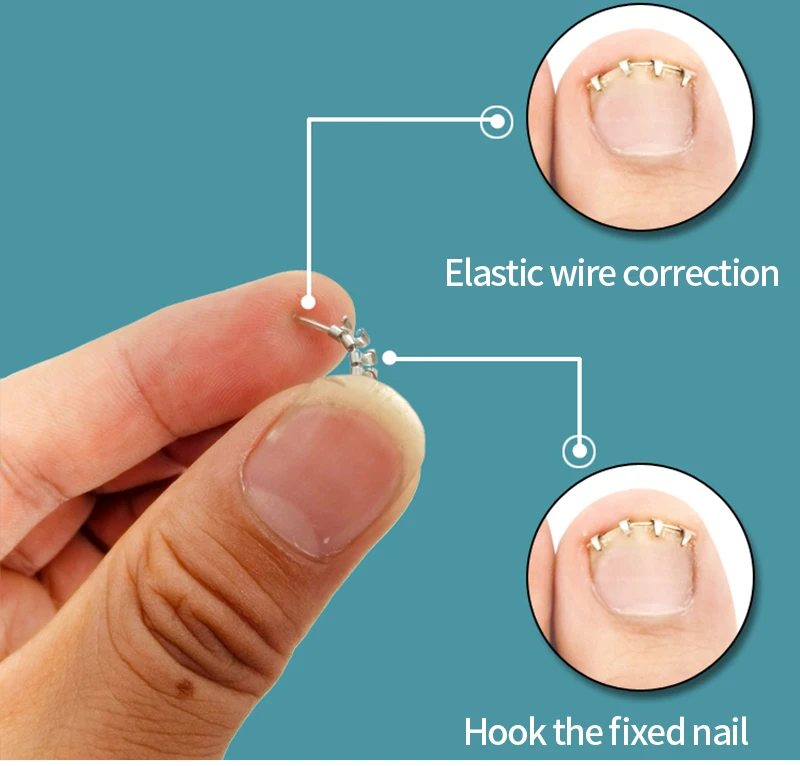 Ingrown Nail Hooktoenail Corrector Orthotic Nail Fixer Toenail ...