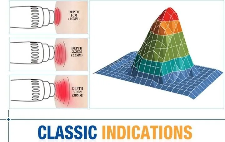 Extracorporeal Shock Wave Shock Therapy Probe Accessories Single Probe ...