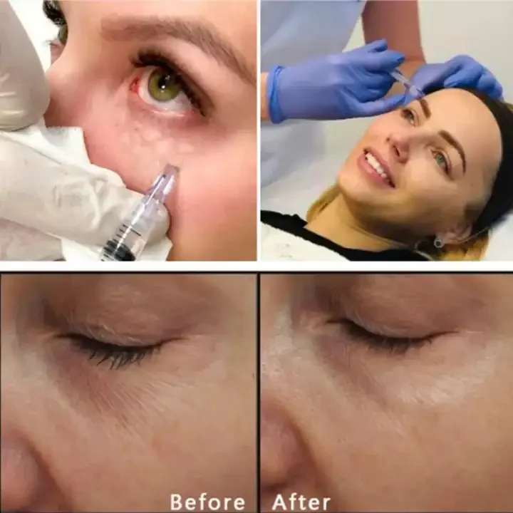 Nanosoft Microneedles Fillmed 3 Pin Needle 34g 1.0mm 1.2mm 1.5mm ...