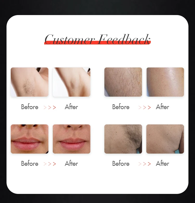 HIDL-808-2000 High Intensity Diode Laser Hair Removal Machine