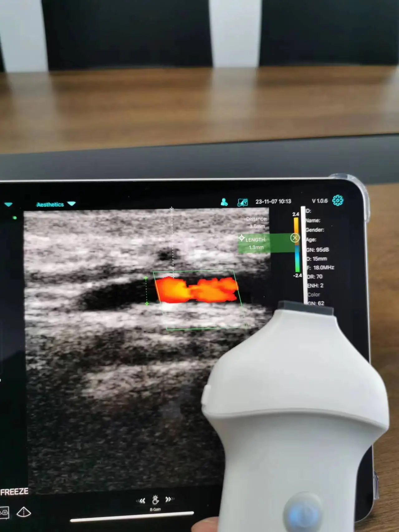 Suresult Konted Wireless Ultrasound Probe C10RL - WiFi iPhone ...