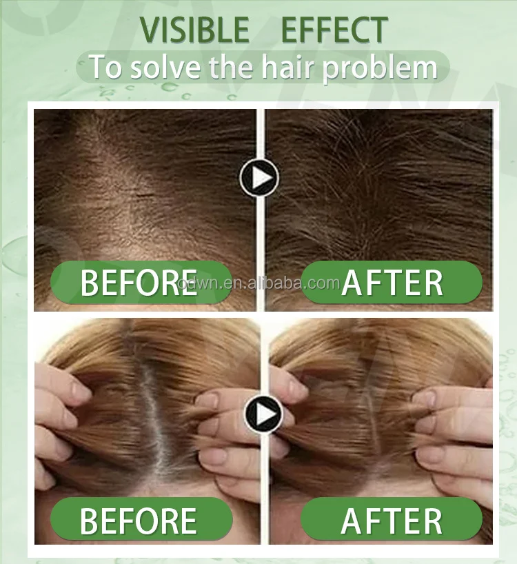 OTVENA Best Hair Solution Organic Hair Nourish Serum Boost Hair Growth ...
