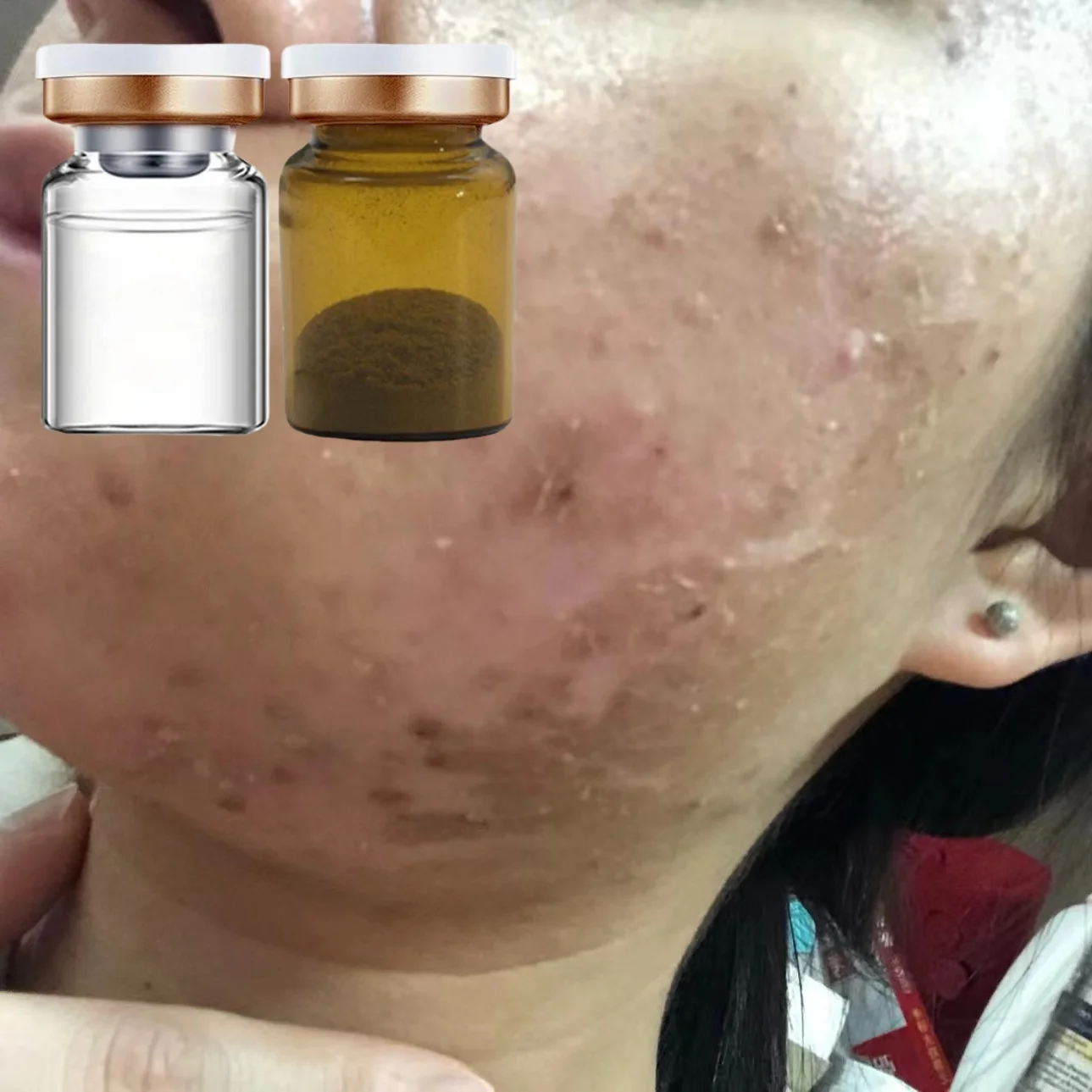40% Spongilla Spicules Bio Spicule Microneedling Spicule Peeling ...