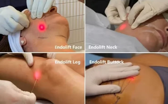 Medical Endolifting Double Chins Check Burn Fat Tighten Skin Face Lift ...