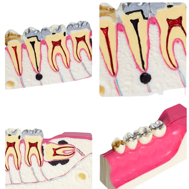 Wisdom Tooth Tissue Disassembly Model Right Lower Posterior Teeth Oral ...