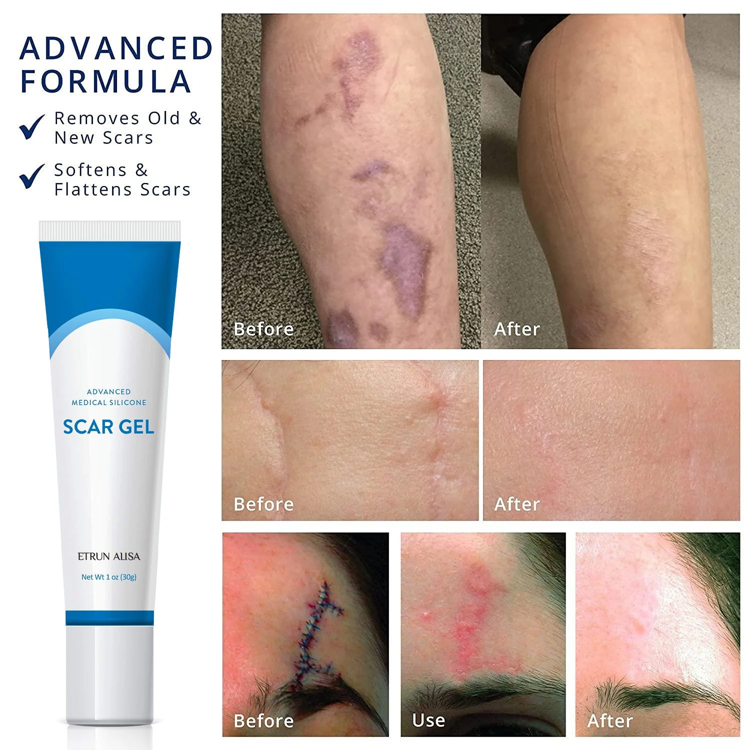 Advanced Scar Gel Medical-Grade Silicone for Face Body Stretch Marks C ...