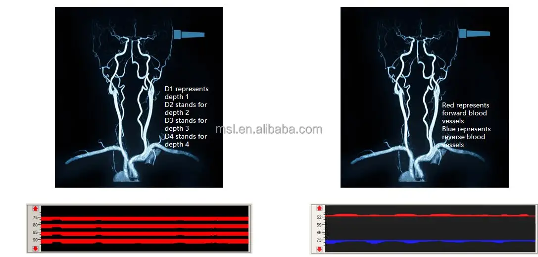 Tcd Transcranial Doppler Ultrasound Machine/ Cerebrovascular Disease ...