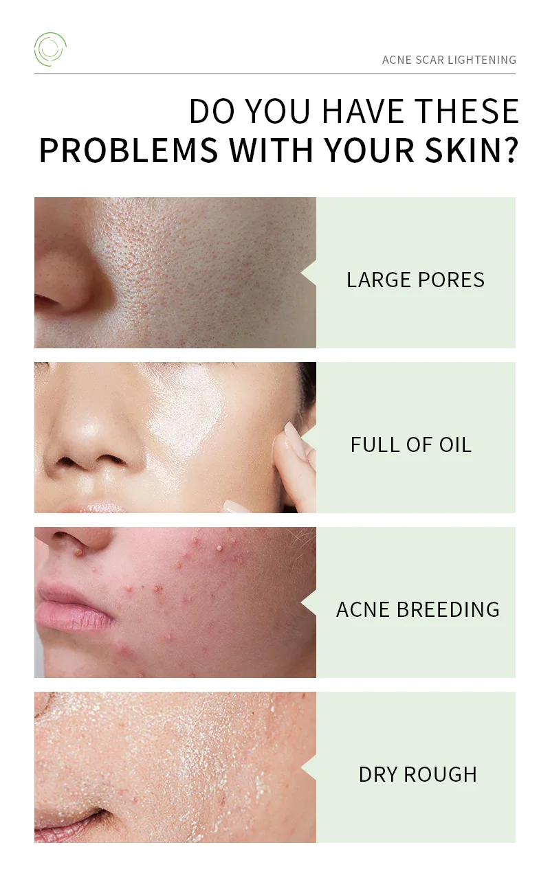 3 Step Repairing Acne Spot Treatment Pore Refining Spot Treatment ...