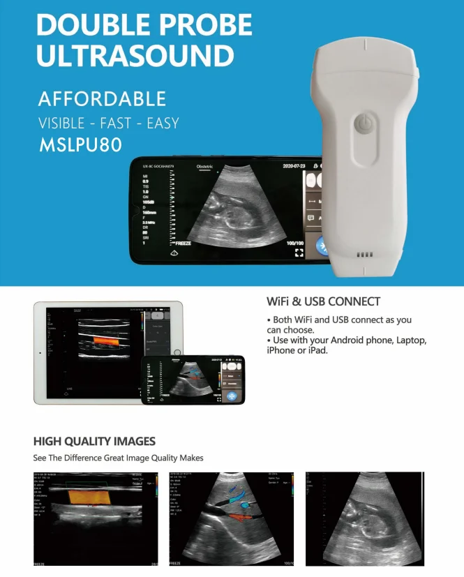 Highest Cost-Effective Double Probes Wireless Color Doppler Ultrasound ...