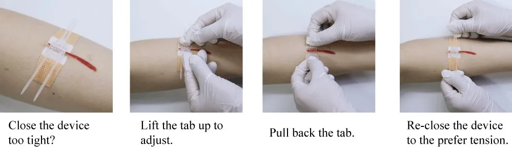 Trummed Medical Zipper - Wound Closure Without Stitches