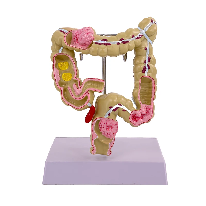 Large Intestine Pathological Model Gastrointestinal Lesions Anatomical ...