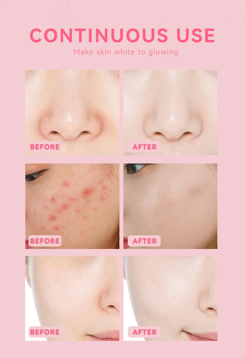 Nicotinamide Acid + Hyaluronic Acid +Vitamin C +Vitamin E 4 in 1 Serum ...