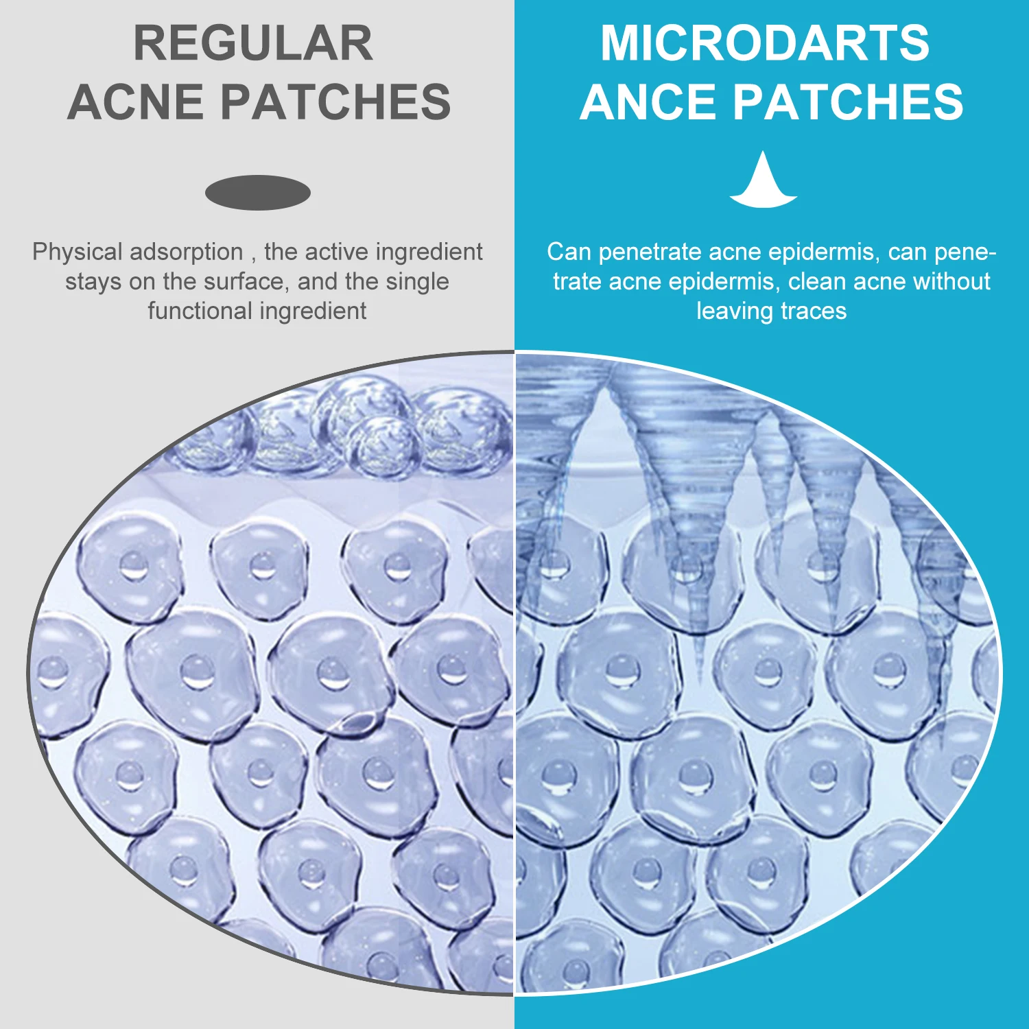 Hyaluronic Acid Microneedle Acne Patch for Fast Healing & Treatment ...