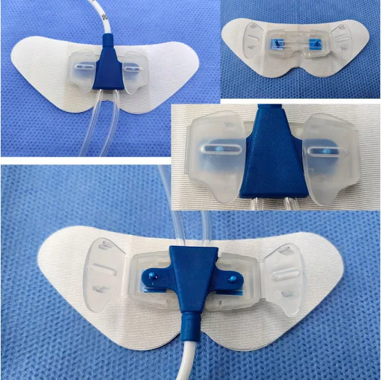 Medical Sicc Picc Drainage Tube Butterfly Buckle Fixation Attached Bile ...