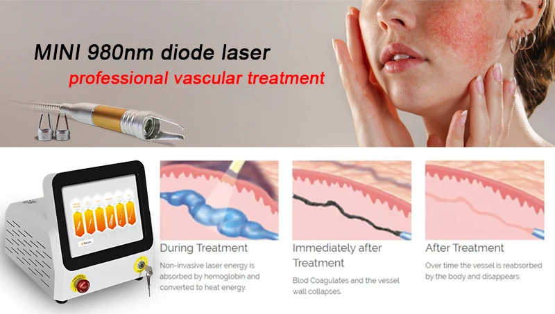 2022 New Arrival Red Blood Portable 980nm Diode Laser Spider Vein ...
