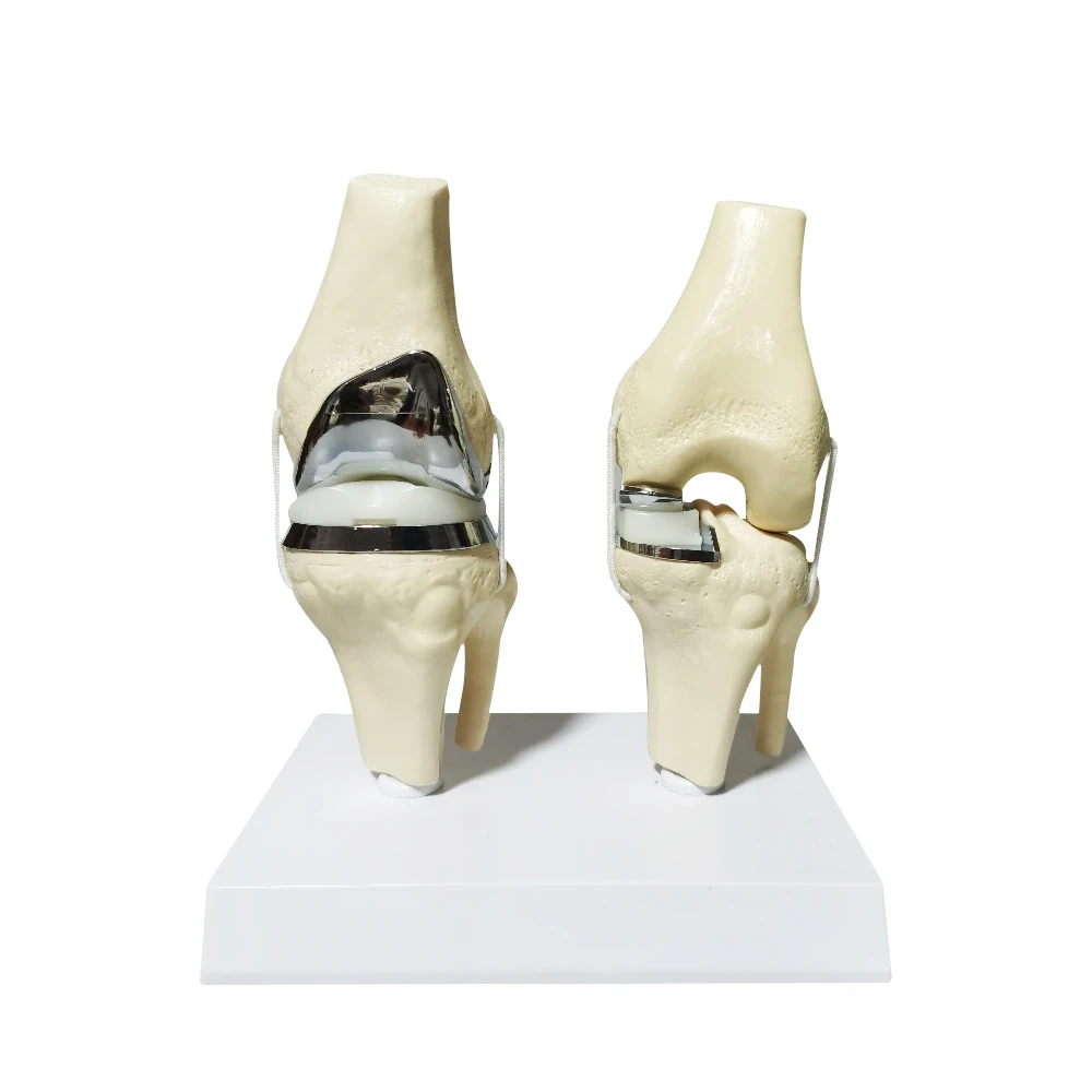 Artificial Knee Joint Model Meniscus Injury Diagnosis Prosthetic Knee ...