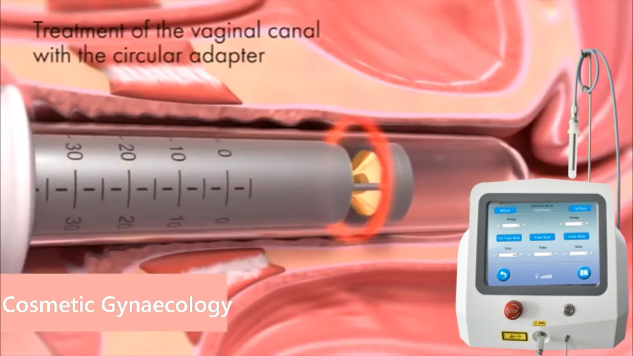 Best Gynecological Diode Laser 980nm 1470nm Vaginal Tightening Laser ...