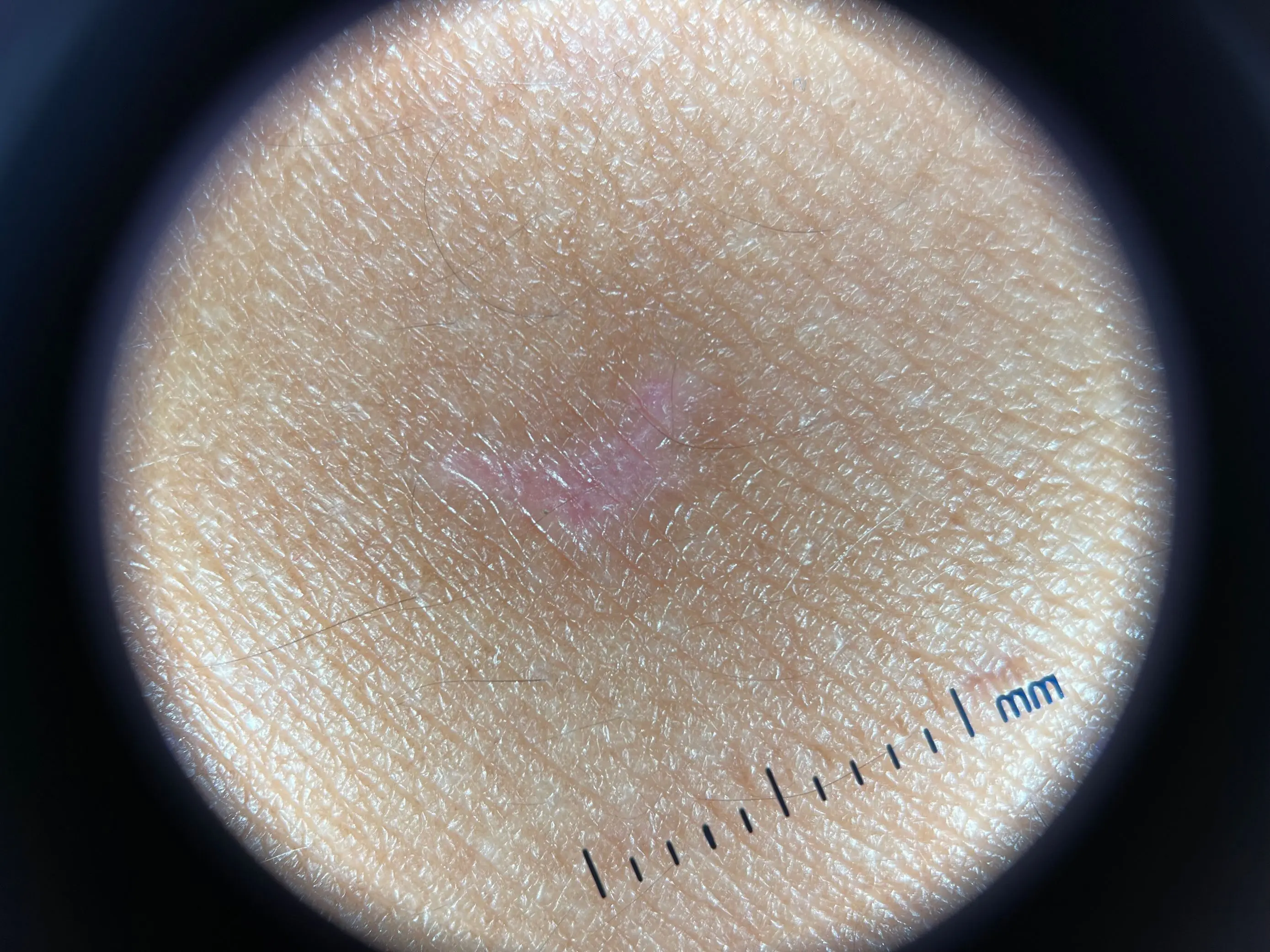 IBOOLO DE-400 Smartphone Polarized Dermatoscope - 10X Magnification