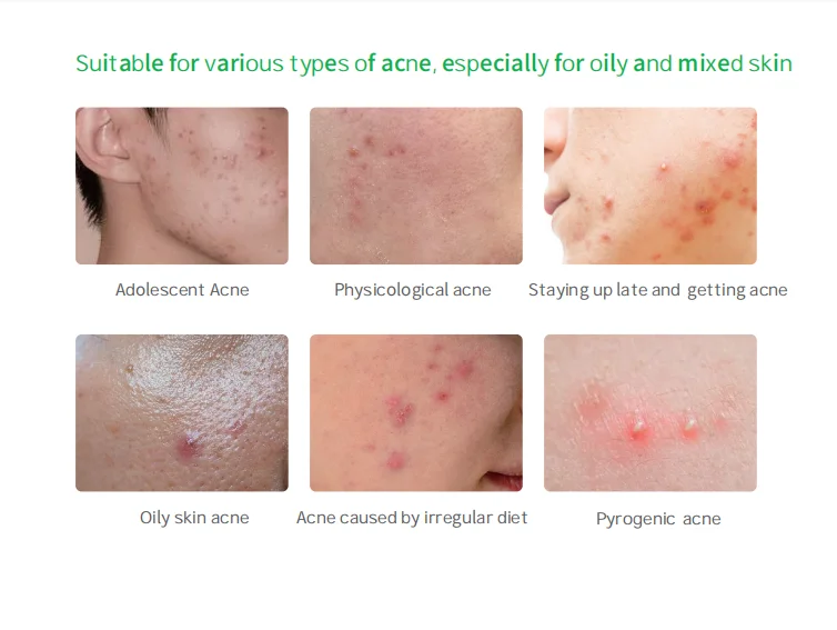 Large Circle Small Circle Acne Patch Wholesale Acne Pimple Patch 12dots ...