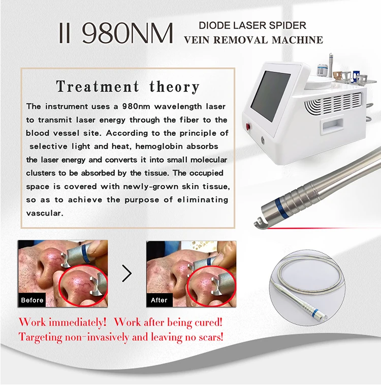 ND YAG KTP Laser for Vascular Removal 1470nm 980nm Vascular Lifting ...
