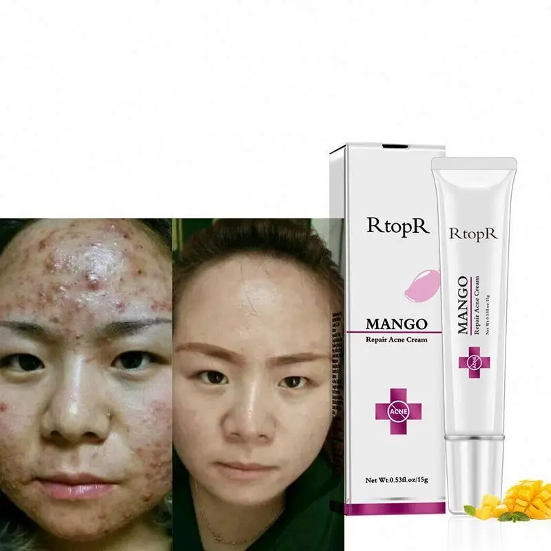 Quick Acne Pimples Care Scar Treatment Spot Removal Anti Acne Herbal ...